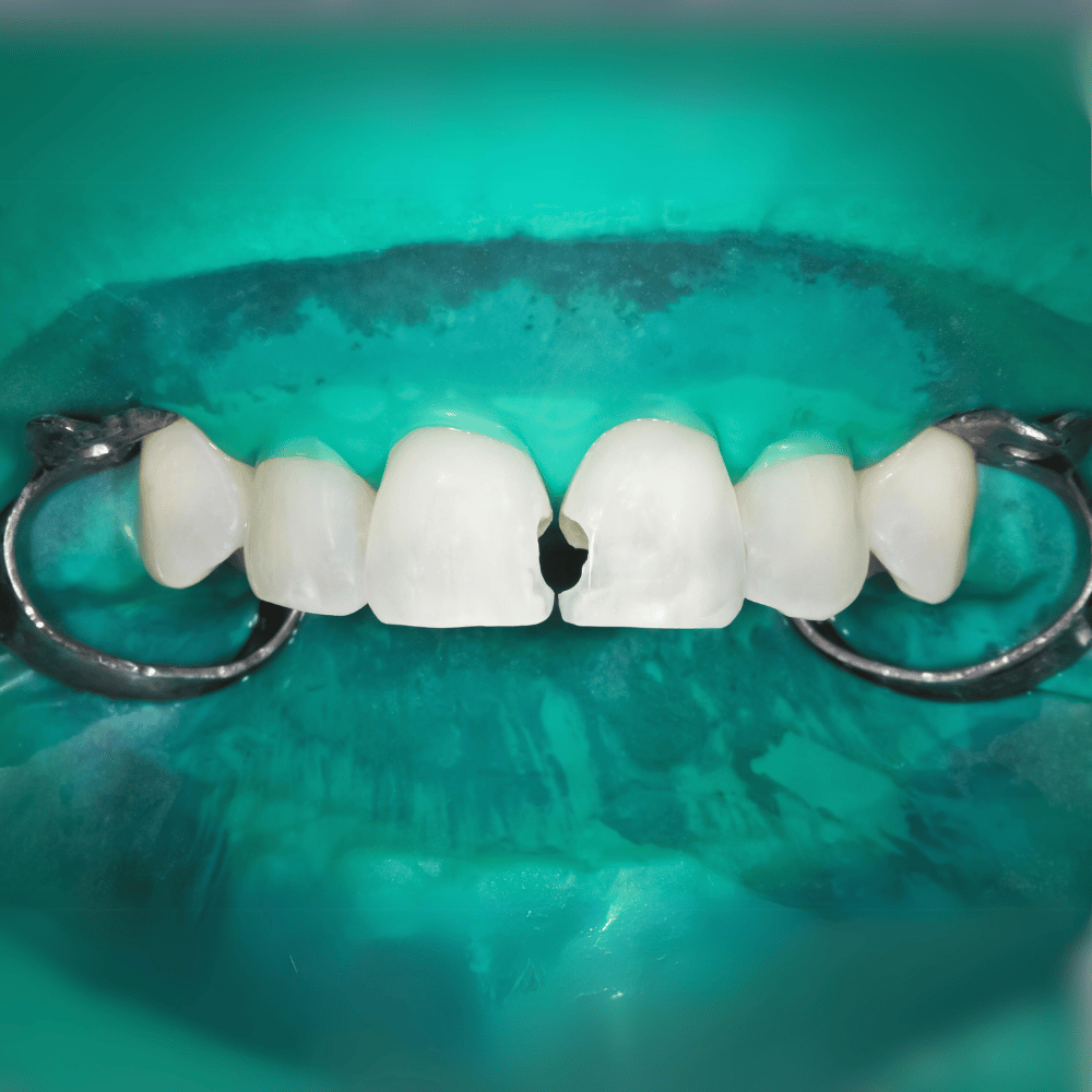 ¿dientes partidos? - Te ayudamos a volver a sonreír con confianza